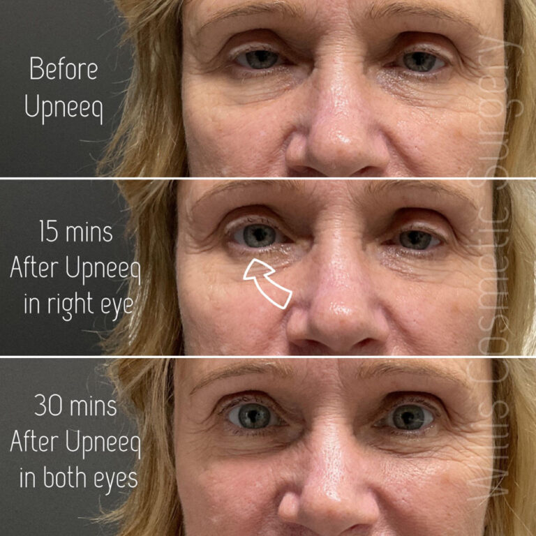 Upneeq | Willis Cosmetic Surgery | Upneeq Before and Afters