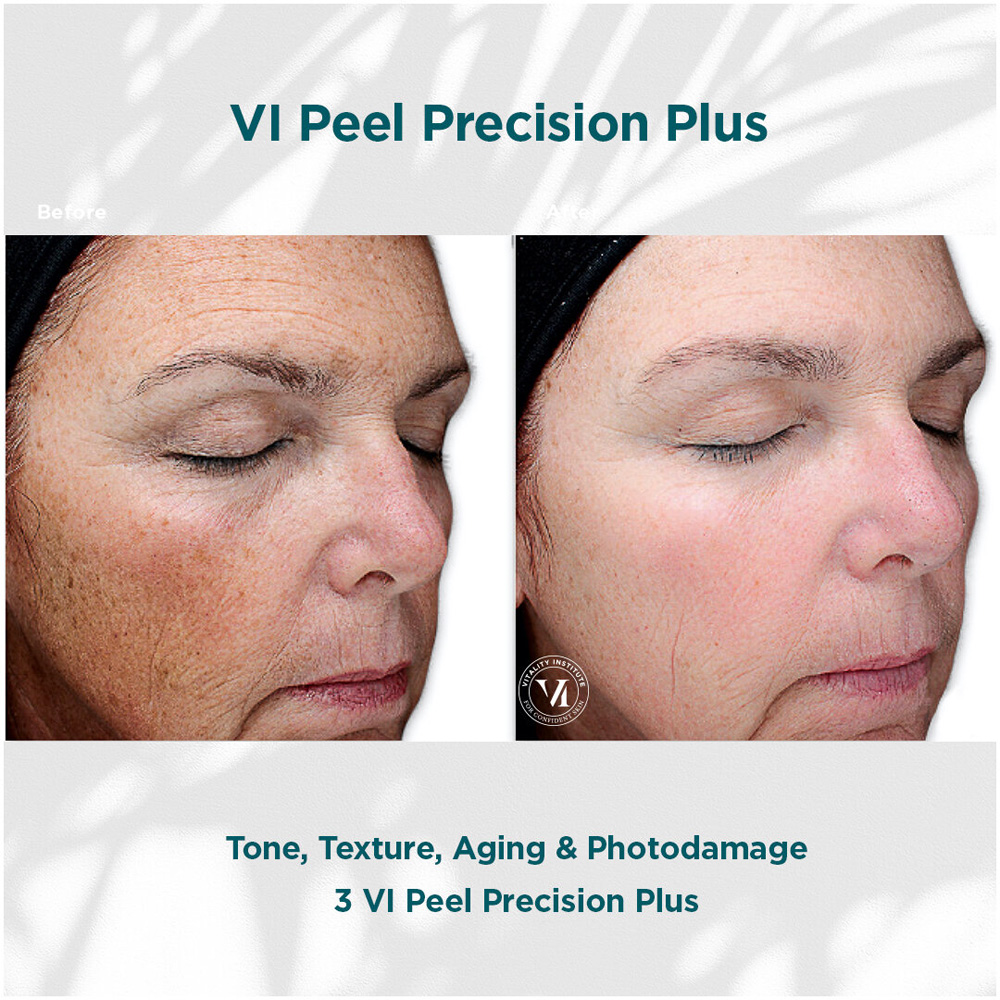 Precision Plus VI Peel Treatment Willis Cosmetic Surgery Precision Plus VI Peel Treatment Willis Cosmetic Surgery