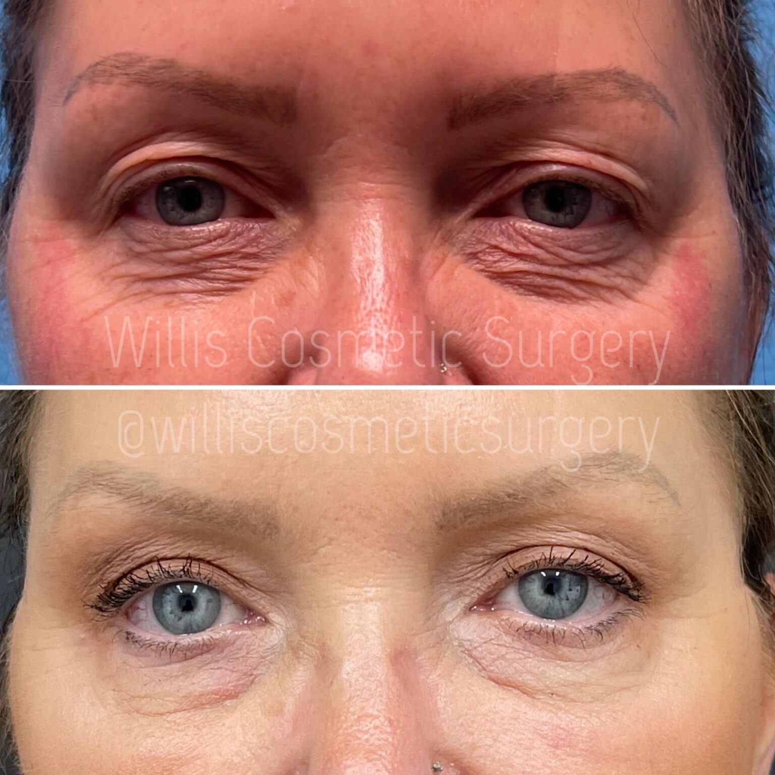 Upper Blepharoplasty | Willis Cosmetic Surgery | Upper Eye Lift St. Louis