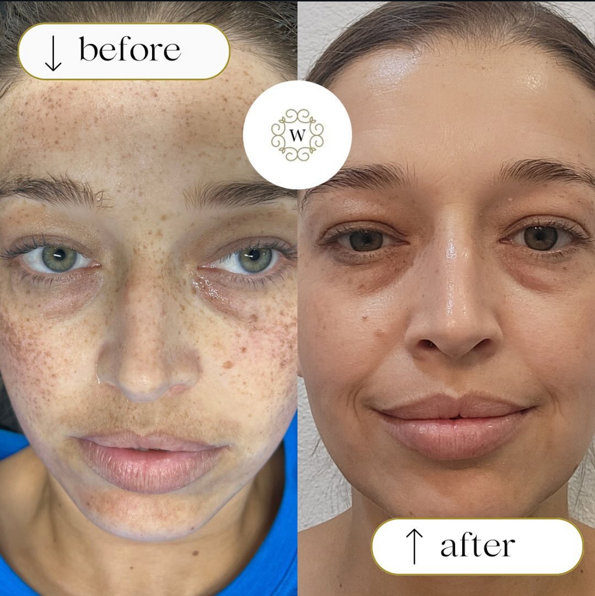 IPL | Willis Cosmetic Surgery | Skin Rejuvenation St. Louis