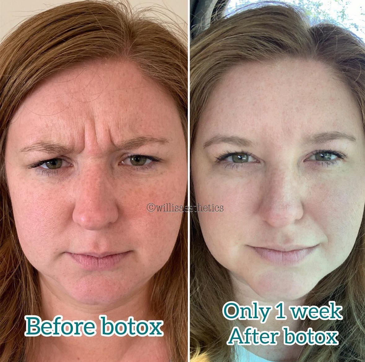Botox 1 Week | Willis Cosmetic Surgery | Botox Ballwin