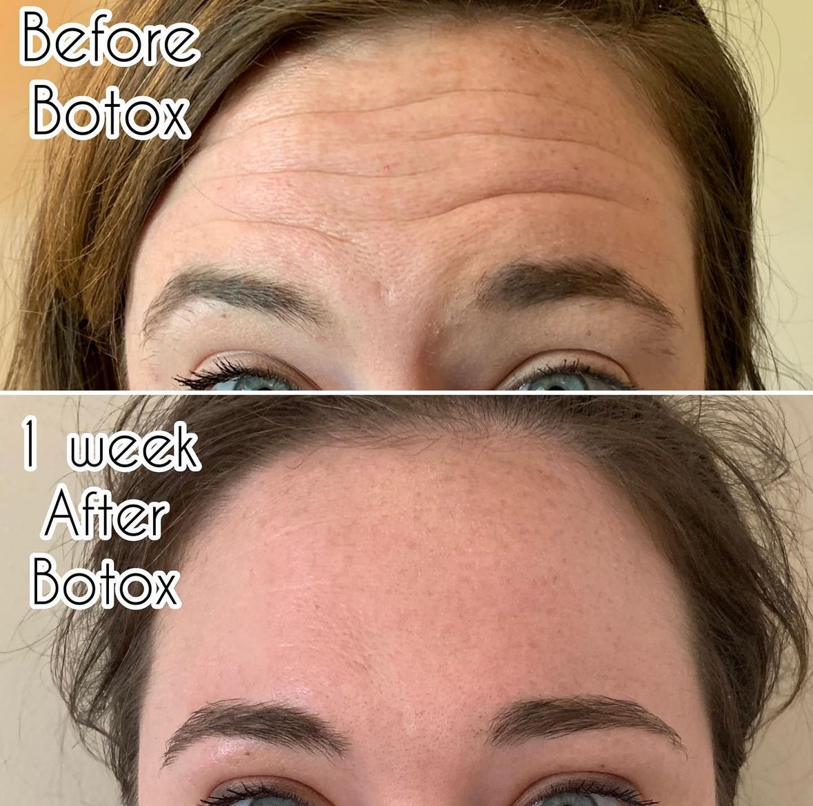 Botox | Willis Cosmetic Surgery | St. Louis Botox
