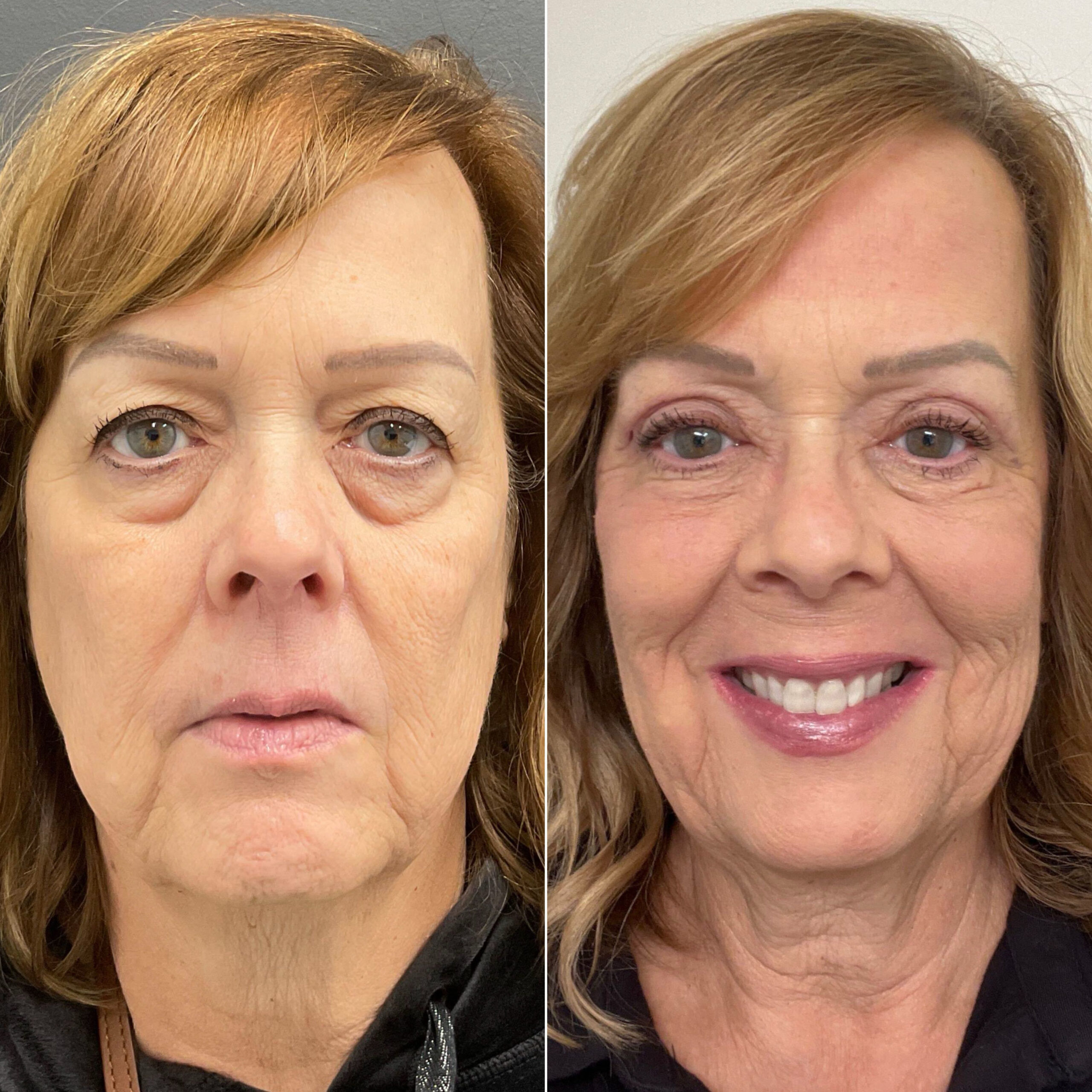 Upper Bleph & Accutite | Willis Cosmetic Surgery | Skin Tightening Ballwin